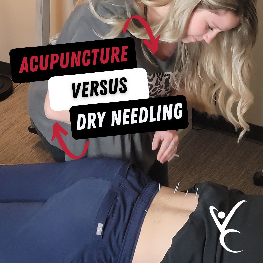 Acupuncture Versus Dry Needling | Venture Chiropractic